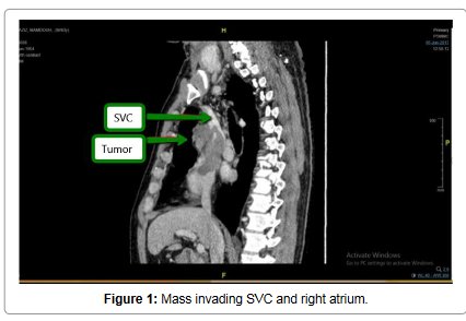 Thymoma Inducing Superior Vena Caval Syndrome