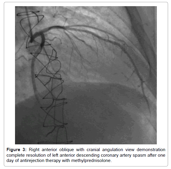 Rapid Resolution of Coronary Artery Spasm Complicated by Acute Sy