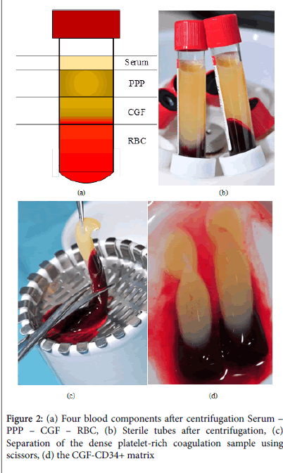 "IPG" DET Minimal Invasive Sinus Implant Placement and Grafting w