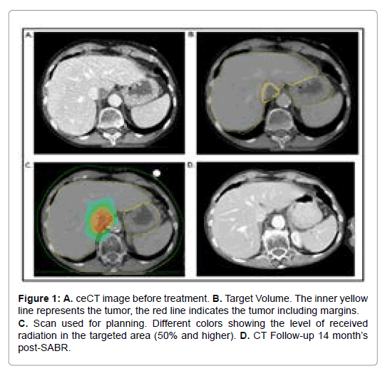 Stereotactic Ablative Radiotherapy to Treat Colorectal Liver Metastases ...