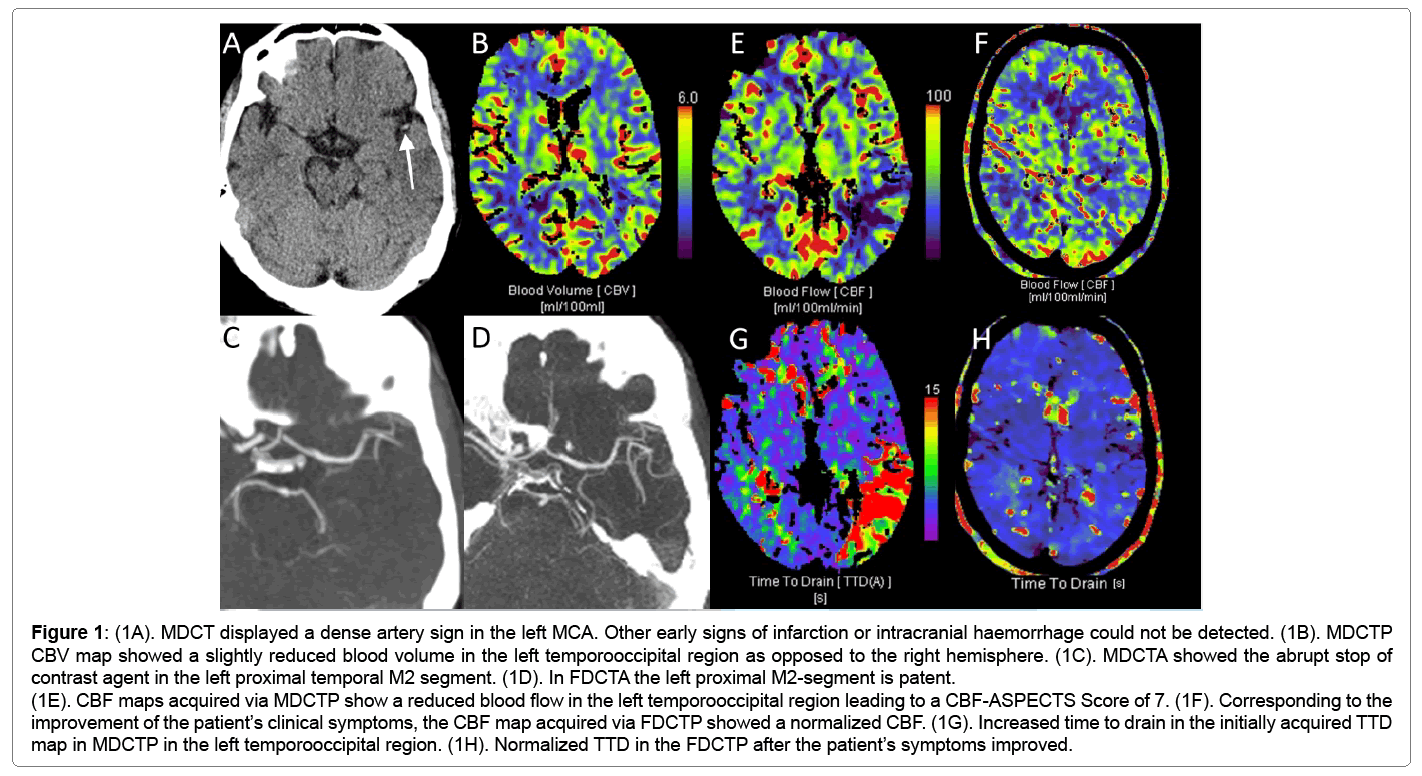 Evaluation of an Acute Stroke Patient with Flat Detector CT Prior