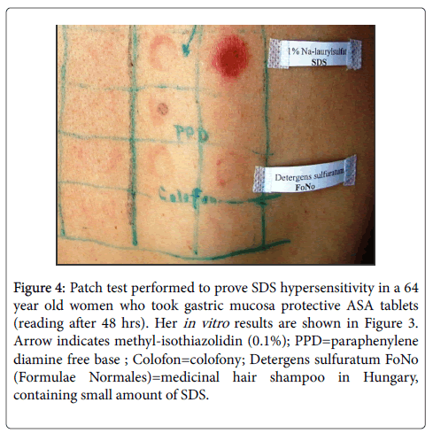 In Vitro Diagnosis of Hypersensitivity to Nonsteroidal Anti-Infla