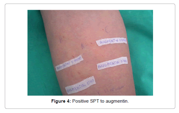 Skin Prick Test in the Diagnosis of Allergy in the Perioperative
