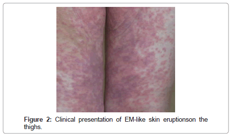 Erythema Multiforme-Like Skin Reaction Induced by Lenalidomide