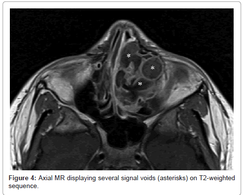 Allergic Fungal Sinusitis in Children