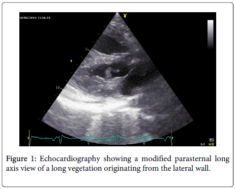 Cardiac Manifestations of Toxocariasis: A Case Report of Loffler ...