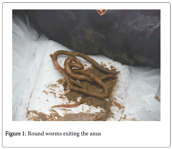 Spontaneous Expulsion through the Anus of Ascaris Lumbricoides in