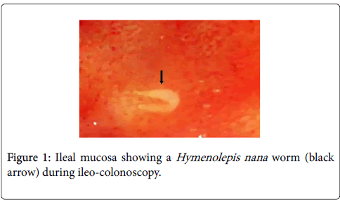 Hymenolepis nana Human Diagnosed through Colonoscopy: A Case Report
