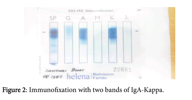 Multiple Myeloma with Biclonal Gammopathy of IgA Kappa Variant: A