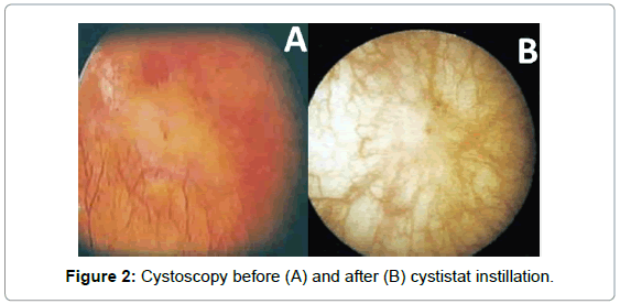 Use of Hyaluronic Acid (Cystistat) for the Treatment of Late Radiation ...