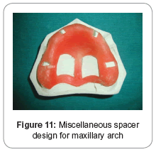 A Clinical Review of Spacer Design for Conventional Complete Denture