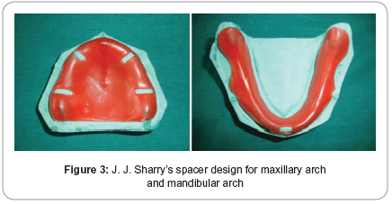 A Clinical Review of Spacer Design for Conventional Complete Dent