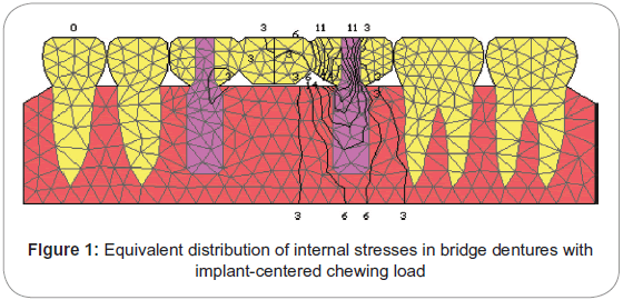 Study of Bridges between Natural Teeth and Implants during Chewing of ...
