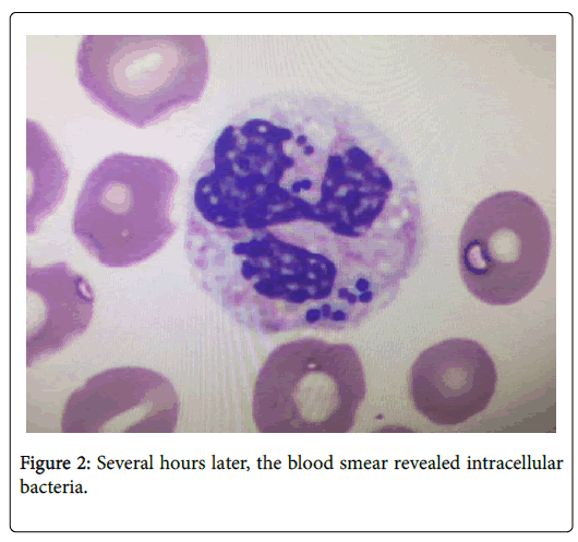 Staphylococcus aureus Sepsis in a Patient with Secondary Acute ...