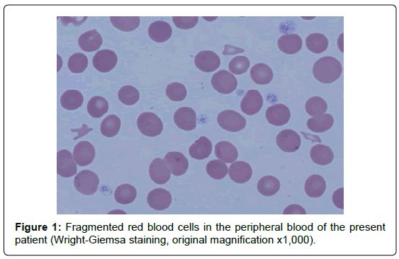 Hemolytic Anemia with Fragmented Red Blood Cells Following Vascular ...