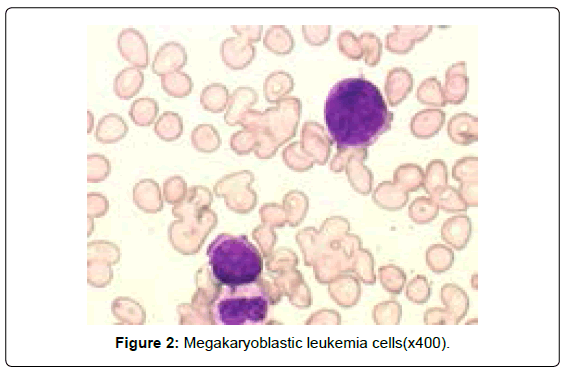 Double Lineage Switch from Acute Megakaryoblastic Leukemia (AML-M7) to ...
