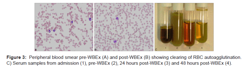 Life-Threatening Autoimmune Hemolytic Anemia Treated with Manual