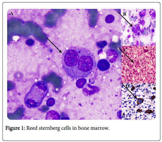 Reed Sternberg Cells in Bone Marrow Touch Imprints