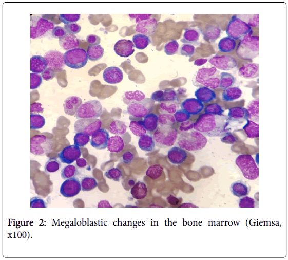 A Case with Pancytopenia and Autoimmune Hemolytic Anemia due to Vitamin ...