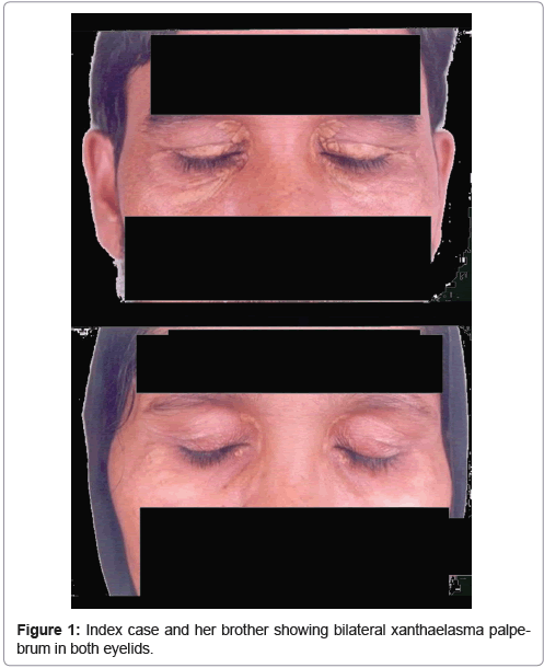 Pleomorphic Xanthomatous Lesions and CAD in a Family