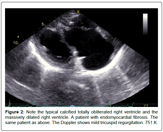 Endomyocardial Fibrosis and the Prothrombotic State: From Hyperco