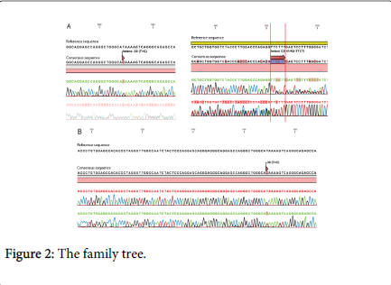Compound Heterozygous -30 (T>C) and Cd 41/42 (-TTCT) Leading t