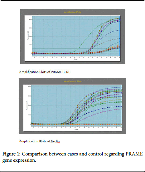 Clinical Importance of PRAME Gene Expression in Acute Myeloid Leukemia