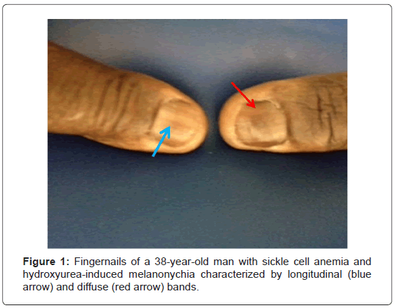 Idiosyncratic Side Effects of Hydroxyurea in Patients with Sickle