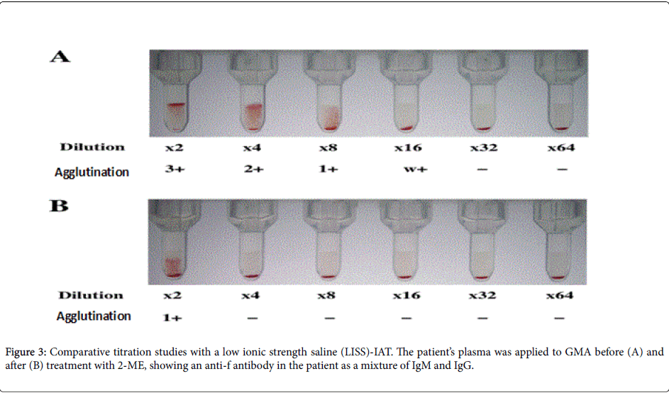Successful Identification of Anti-f Alloantibody in a Non-transfused ...