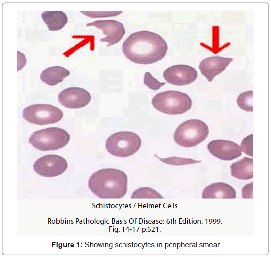 Thrombotic Thrombocytopenic Purpura