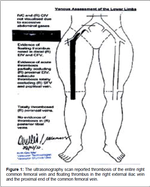 Pulmonary Embolism-A Mechanical Compression Effect on Lower Limb Deep ...