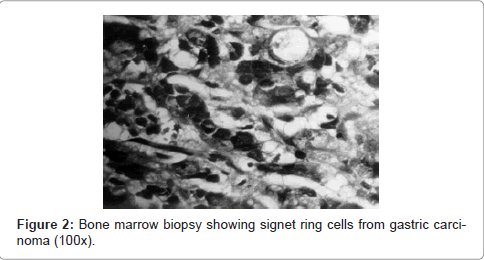 Metastatic Bone Marrow Tumors: Study of Nine Cases and Review of the ...