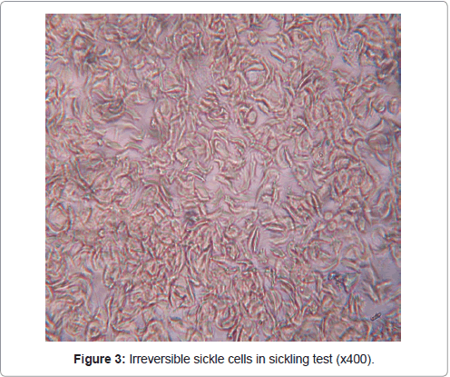 Basal Ganglia Infarct in an Infant with Sickle Cell Disease - A Rare ...