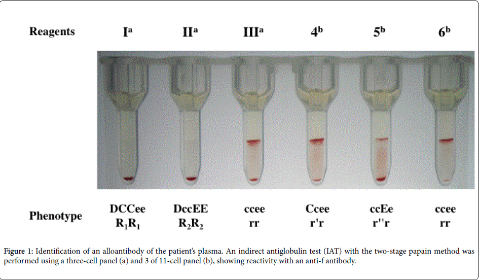 Successful Identification of Anti-f Alloantibody in a Non-transfused ...