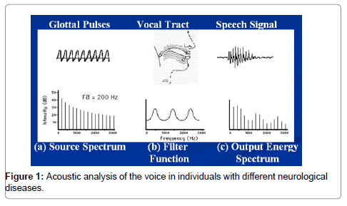 Dysarthrophonia in Association with Voice Analysis: A Case Report