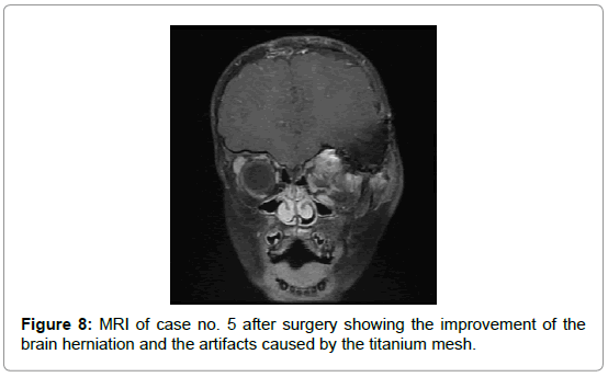 Skull Base Reconstruction with Titanium Mesh for Benign Complex ...