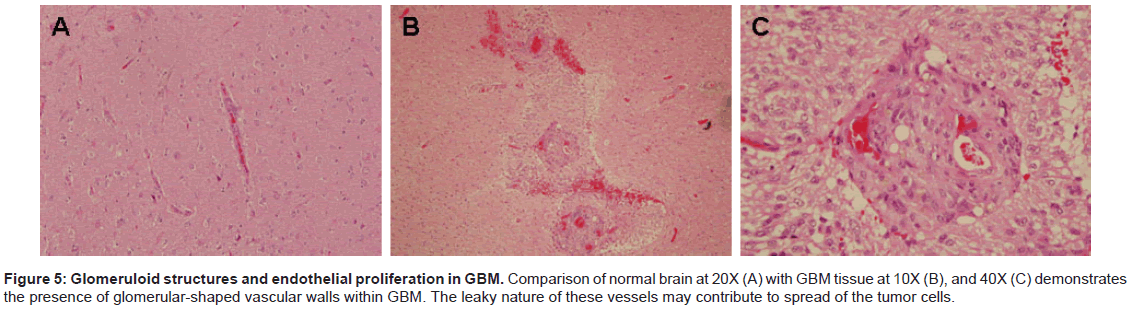 Glioma Stem Cells and their Therapy Resistance