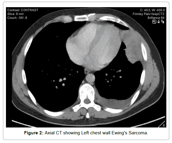 Sarcomas and Hypertrophic Pulmonary Osteoarthropathy