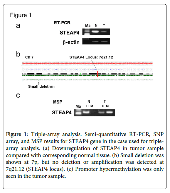 STEAP4 Inactivation Correlates Poor Prognosis and might be a Possible ...