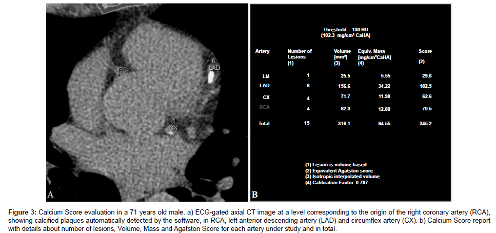 Comparison between Carotid Artery Doppler Ultrasound and Coronary