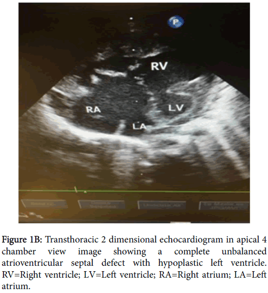 Down Syndrome with Unbalanced Complete Atrioventricular Septal De