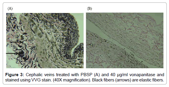 Recombinant Human Elastase Treatment of Cephalic Veins