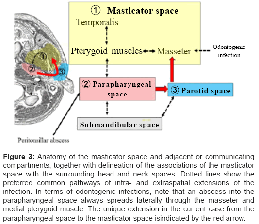 Unique Extension of Peritonsillar Abscess to the Masticator Space