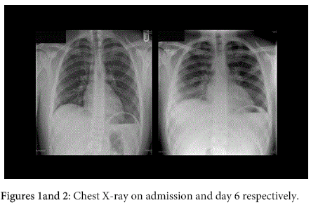 Lemierre’s Syndrome: The Forgotten Disease?