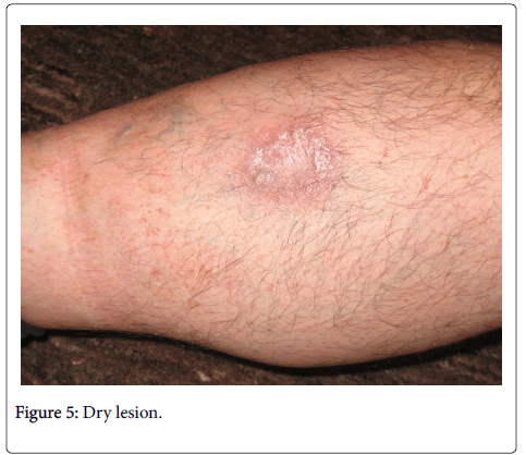 Cutaneous Leishmaniasis with Long Duration and Bleeding Ulcer