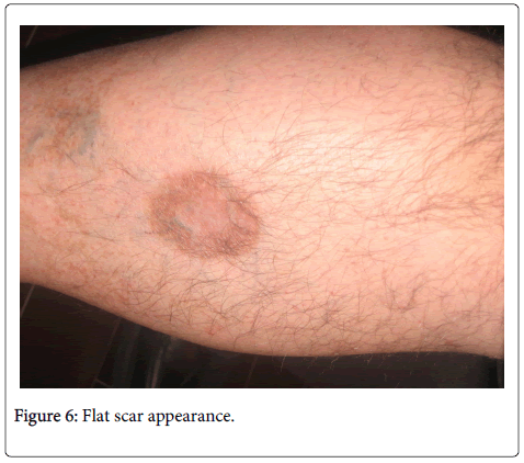 Cutaneous Leishmaniasis with Long Duration and Bleeding Ulcer