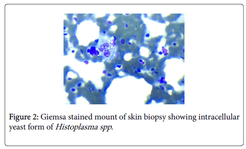 Cutaneous Histoplasmosis and Role of Direct Microscopy-A Case Rep
