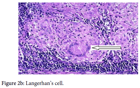 Free Perforation of Ileal Tubercular Ulcer- A Case Report and Lit