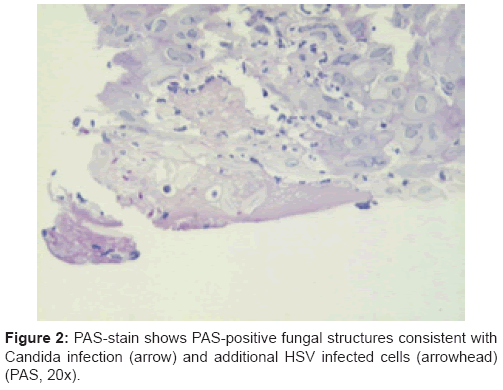 Practical Aspects in the Evaluation of Infectious Esophagitis