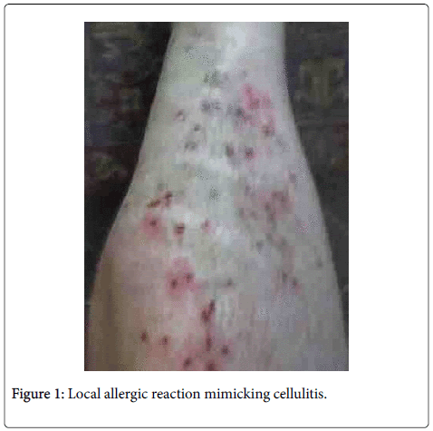 Cutaneous Leishmaniasis with Long Duration and Bleeding Ulcer